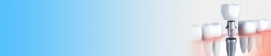 Dental Implants in Hartlepool - Bentley Mathieson Dentalcare