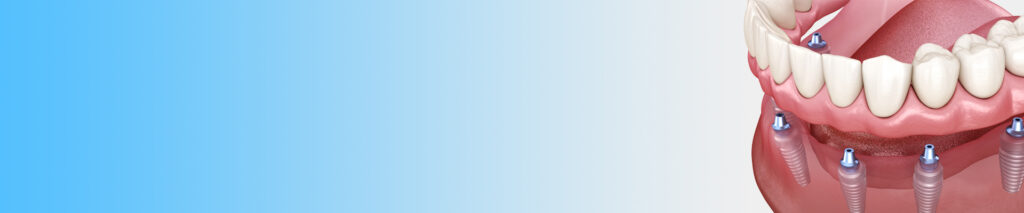 Denture Stabilisation Hartlepool - Bentley Mathieson Dentalcare